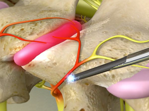 Cervical Facet Radiofrequency Neurotomy - Direct Orthopedic Care