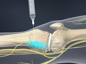 Genicular Nerve Block (G Block) - Direct Orthopedic Care